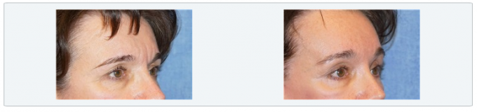 Cross Linked Hyaluronic Acid Dermal Fillers Breast Enhancement With Lidocaine