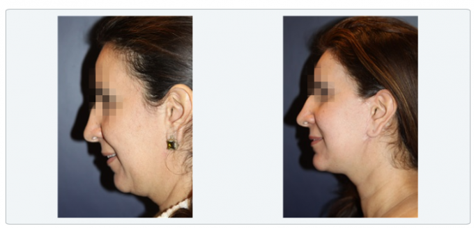 Hyaluronic Acid For Breast Enlargement Injectable Breast Fillers Breast ...