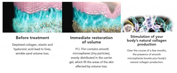 PCL Dermal Filler Promote Collagen Production Filling Wrinkles
