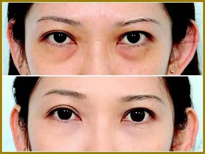 HA Injectable Dermal Fillers For Removing Eyes Black Circle Tear Troughs