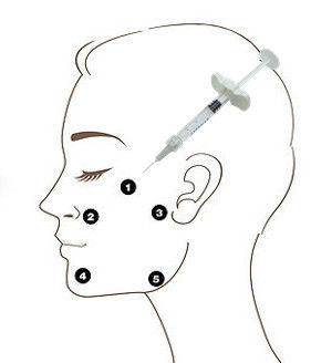 OEM Profhilo H+L 32mg Non Cross Linked Hyaluronic Acid Filler 5 Points ...