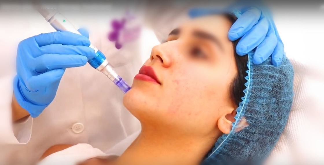 20mg/Ml Non Cross Linked HA Dermal Filler Anti-Aging Ha For Hyaluron Pen